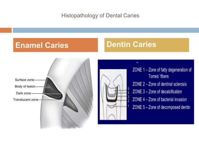 Dental caries ppt