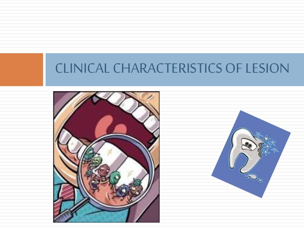 Dental caries ppt