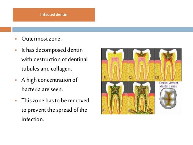 Dental caries ppt