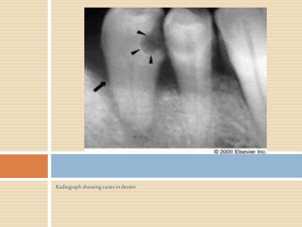 Dental caries ppt