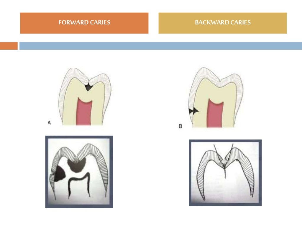 Dental caries ppt