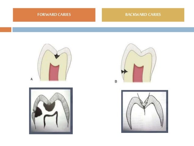 Dental caries ppt