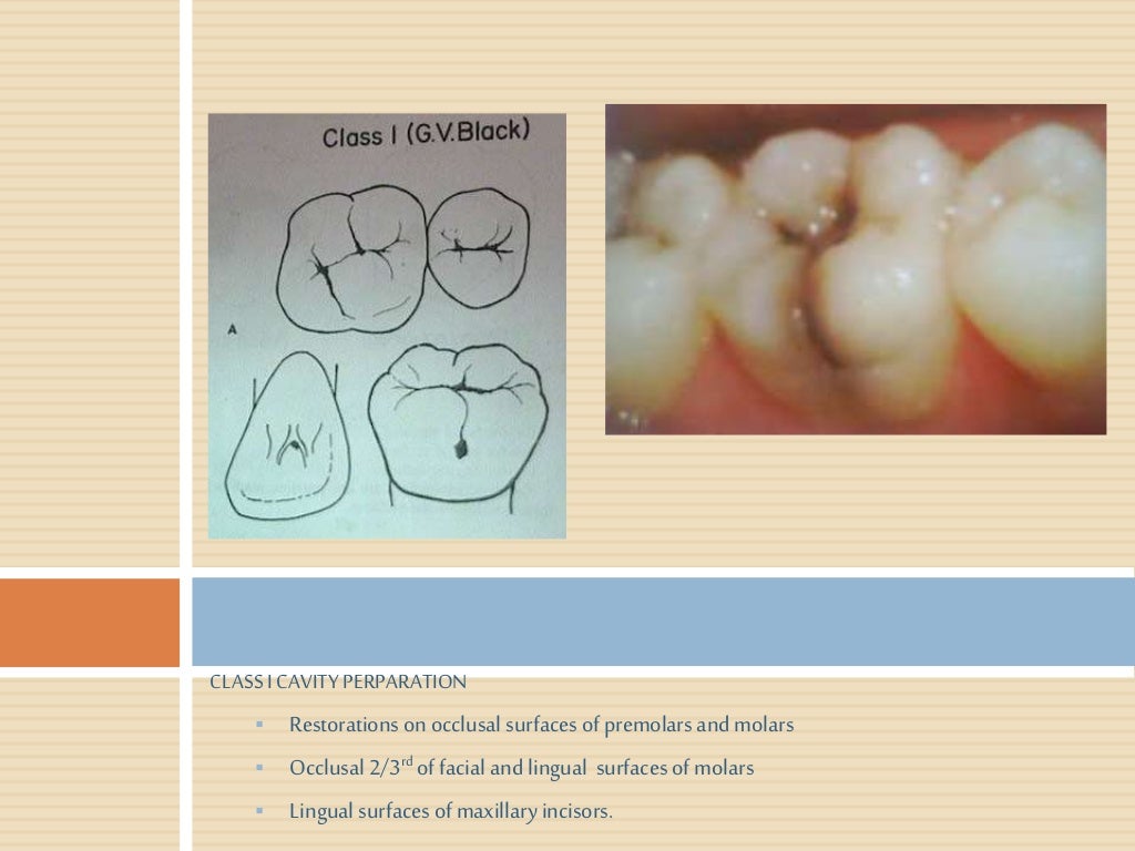 Dental caries ppt