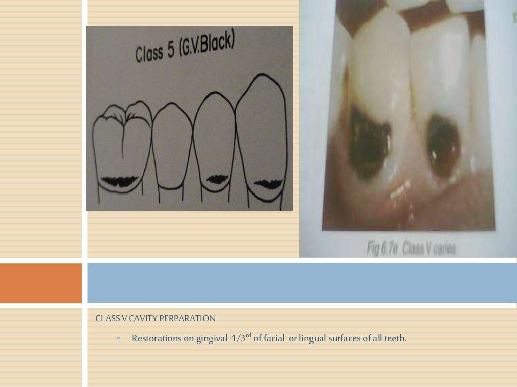 Dental caries ppt