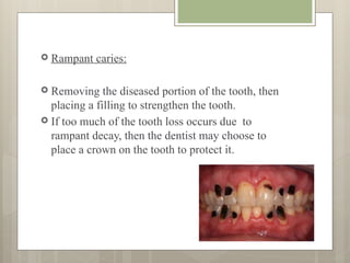 dental caries ,recent advances,prevention,treatment | PPTX