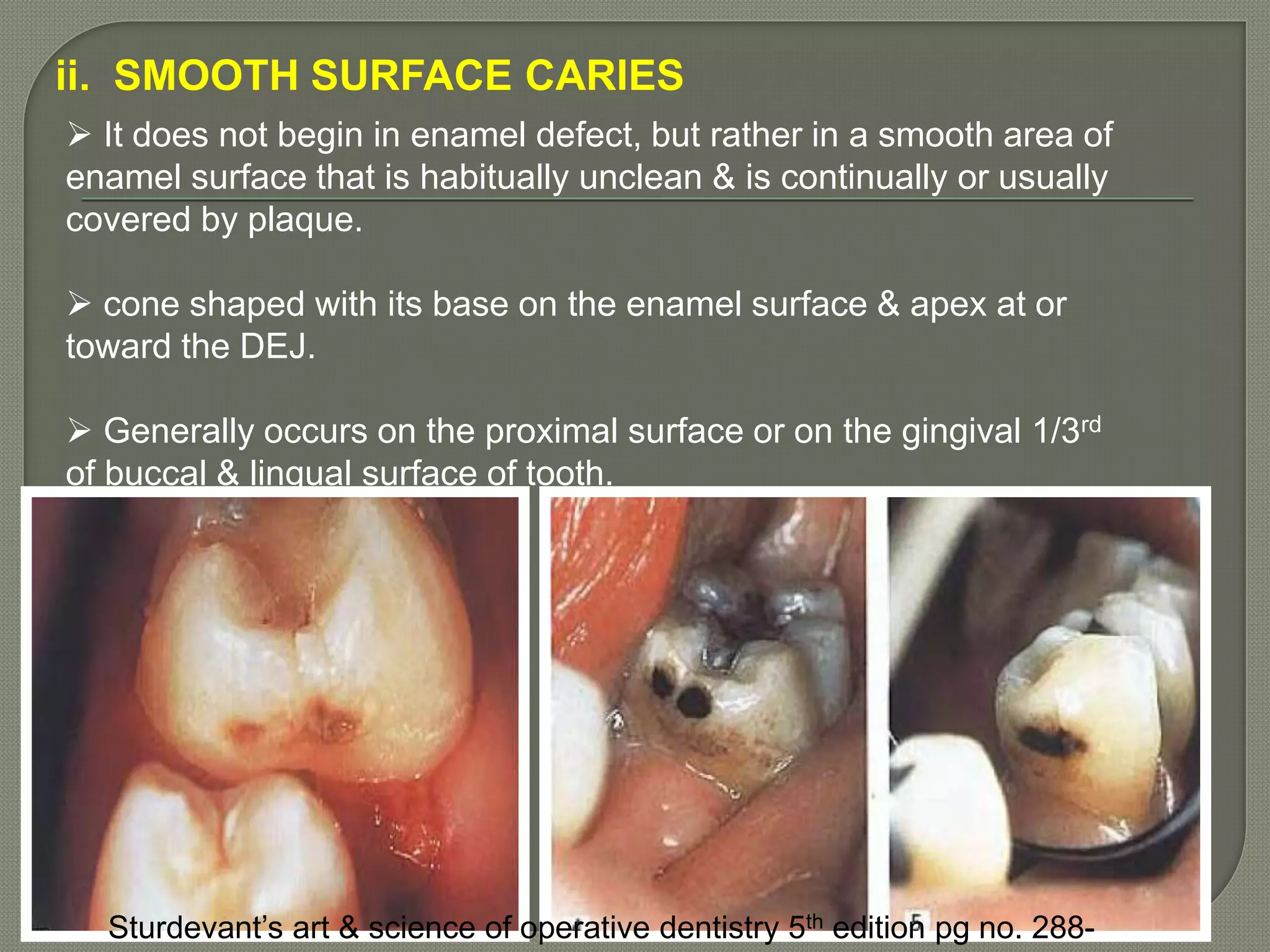 Dental caries (operative dentistry) | PPTX