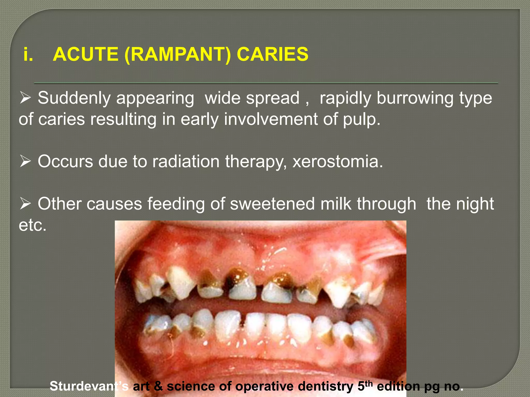 Dental caries (operative dentistry) | PPTX
