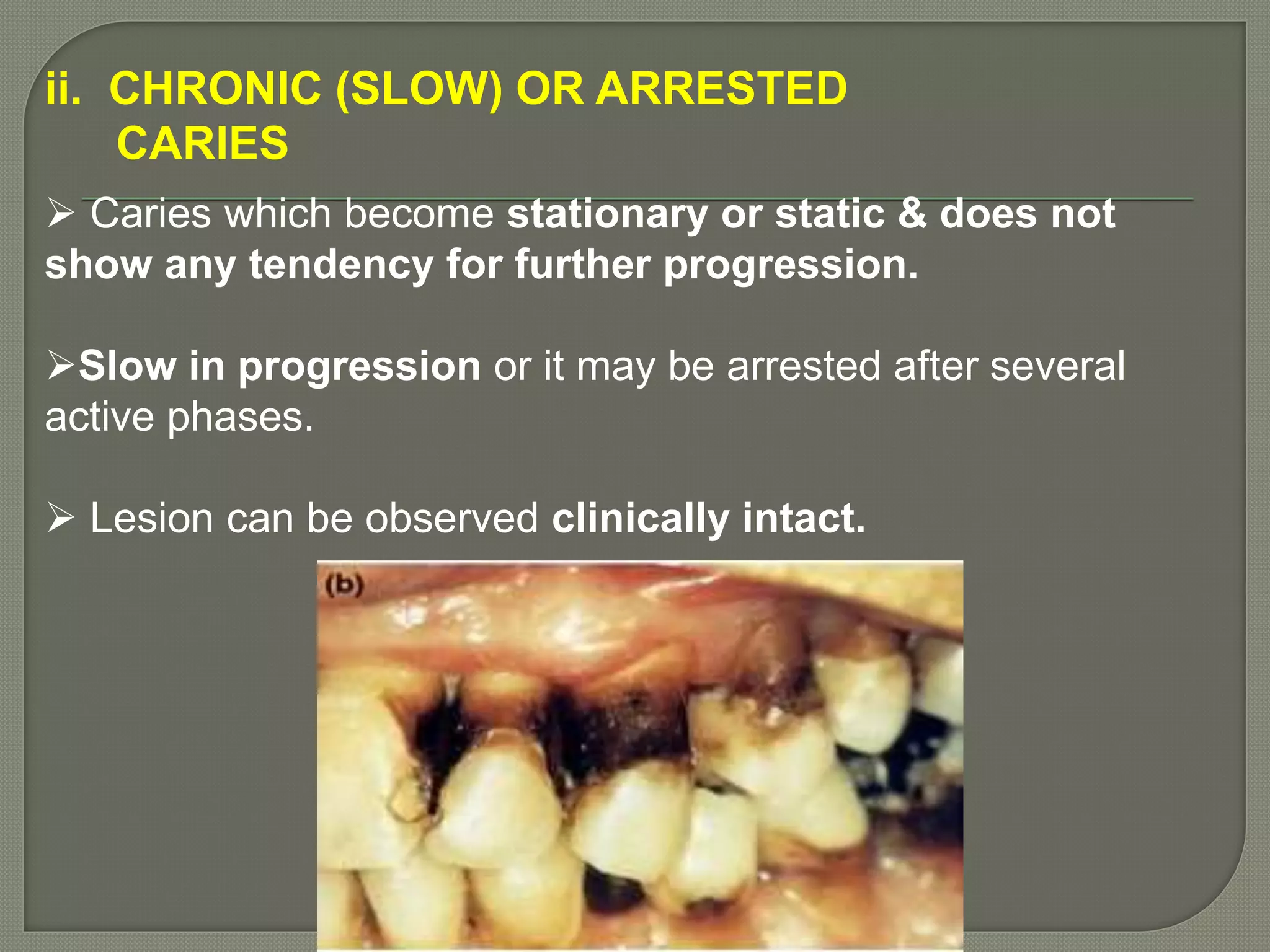 Dental caries (operative dentistry) | PPTX
