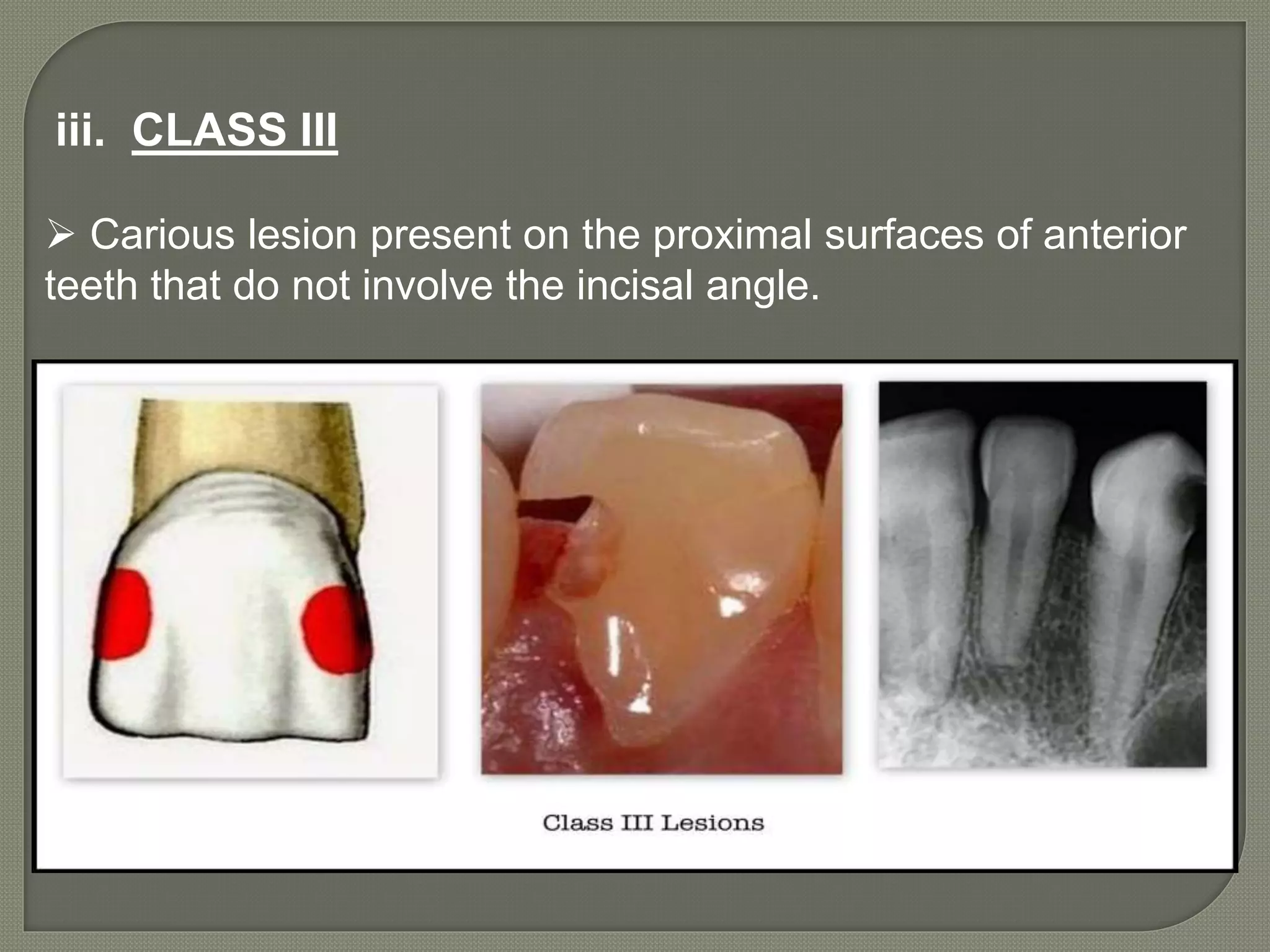 Dental caries (operative dentistry) | PPTX