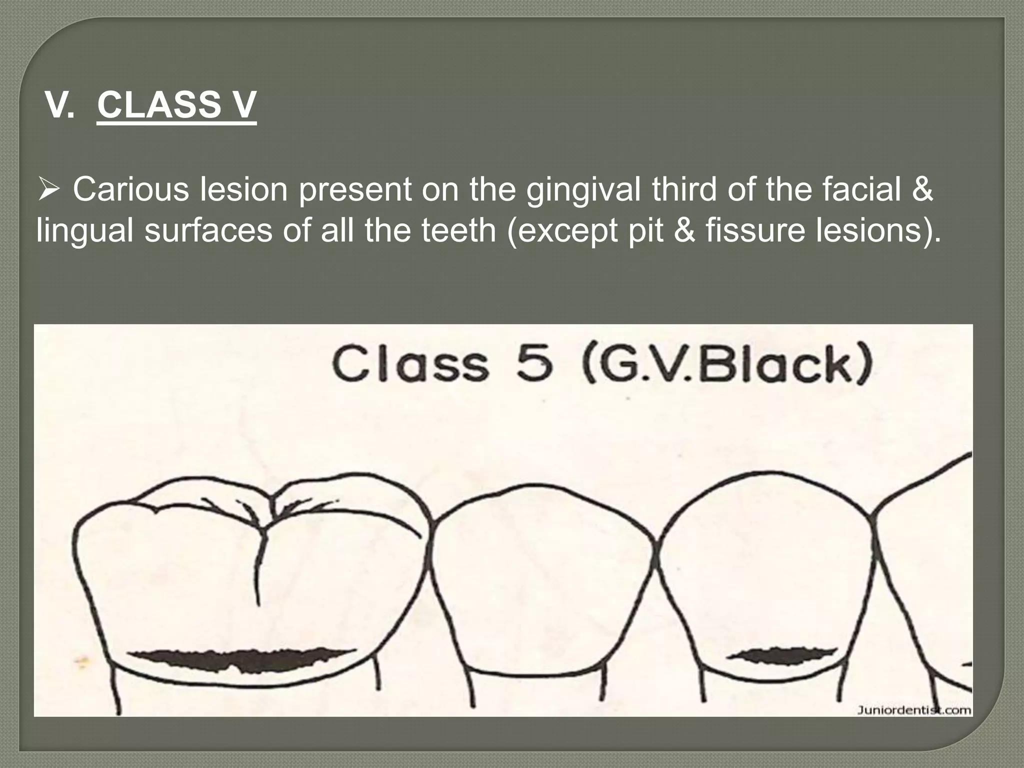 Dental caries (operative dentistry) | PPTX