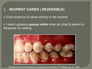 Dental caries (operative dentistry) | PPTX