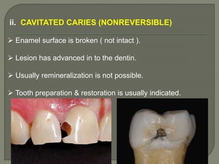 Dental caries (operative dentistry) | PPTX