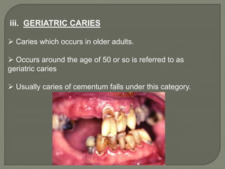 Dental caries (operative dentistry) | PPTX