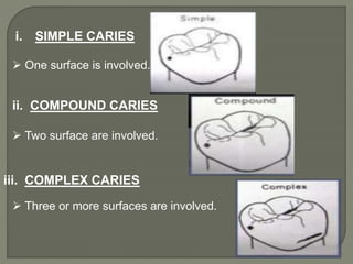 Dental caries (operative dentistry) | PPT