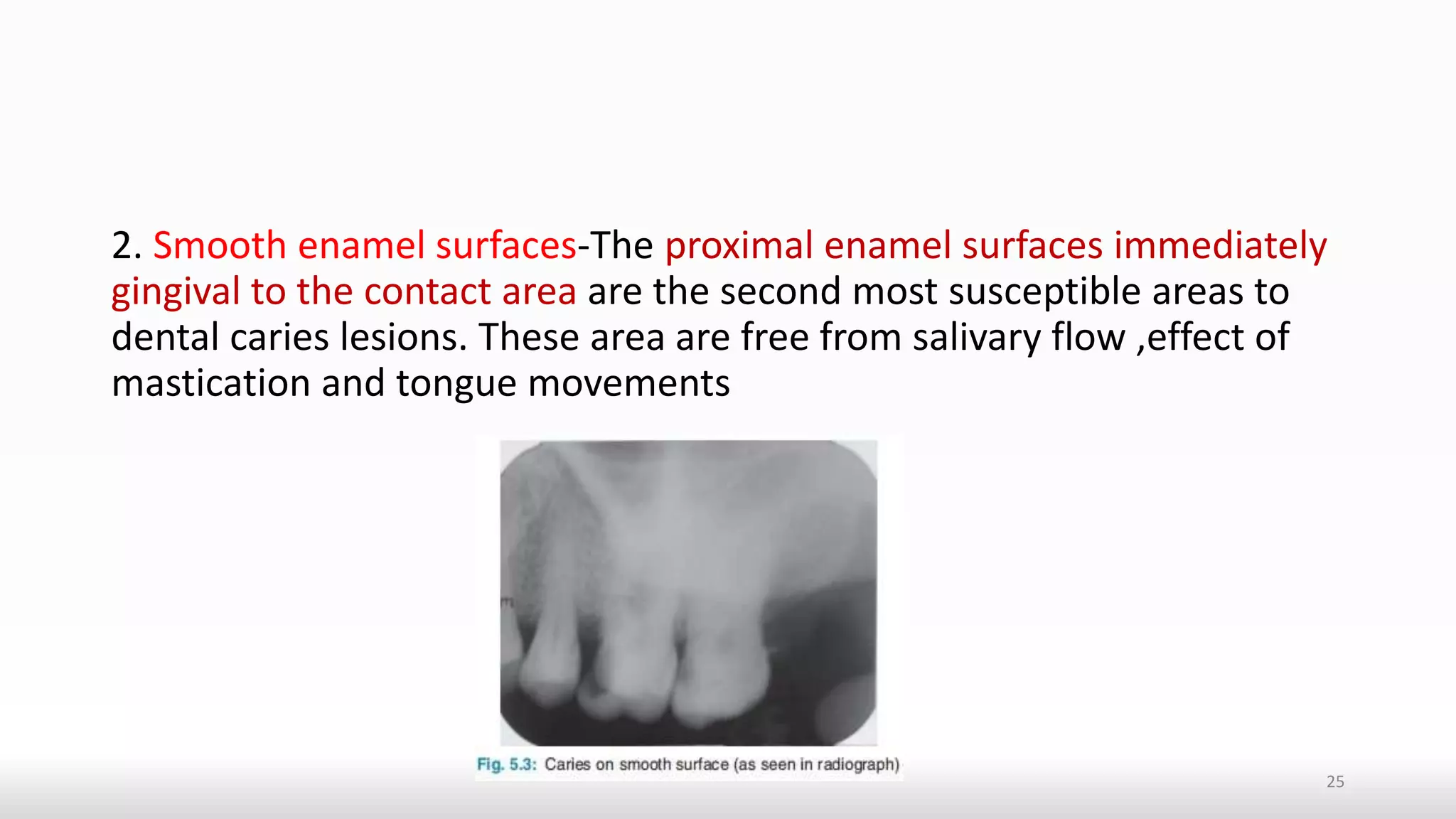 Dental caries etiology, theories and prevention | PPTX