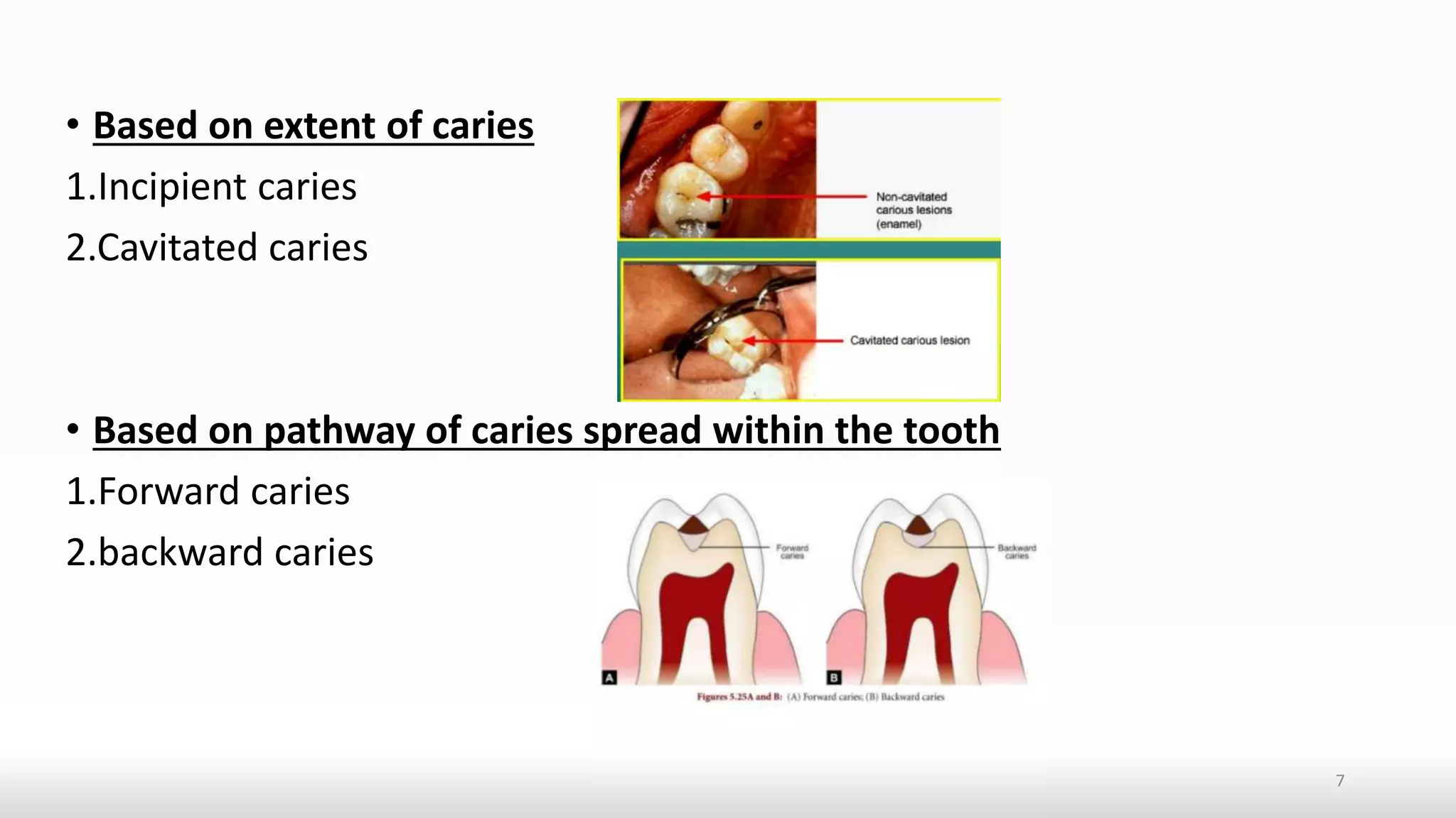 Dental caries etiology, theories and prevention | PPTX