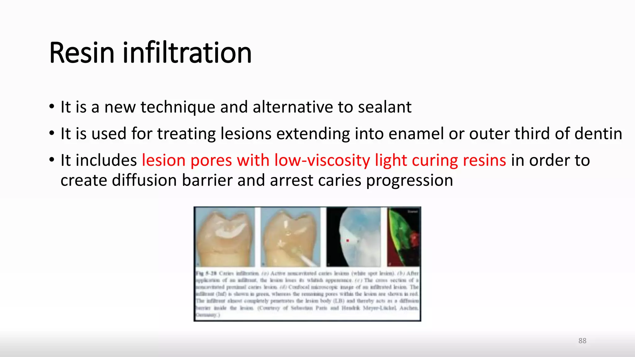 Dental caries etiology, theories and prevention | PPTX