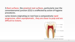 Dental caries etiology, theories and prevention | PPTX
