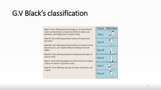 Dental caries etiology, theories and prevention | PPTX