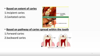 Dental caries etiology, theories and prevention | PPT