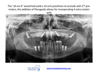 Dental case: maxillary modification of an all-on-4 Dr. Virgilio Mongalo ...