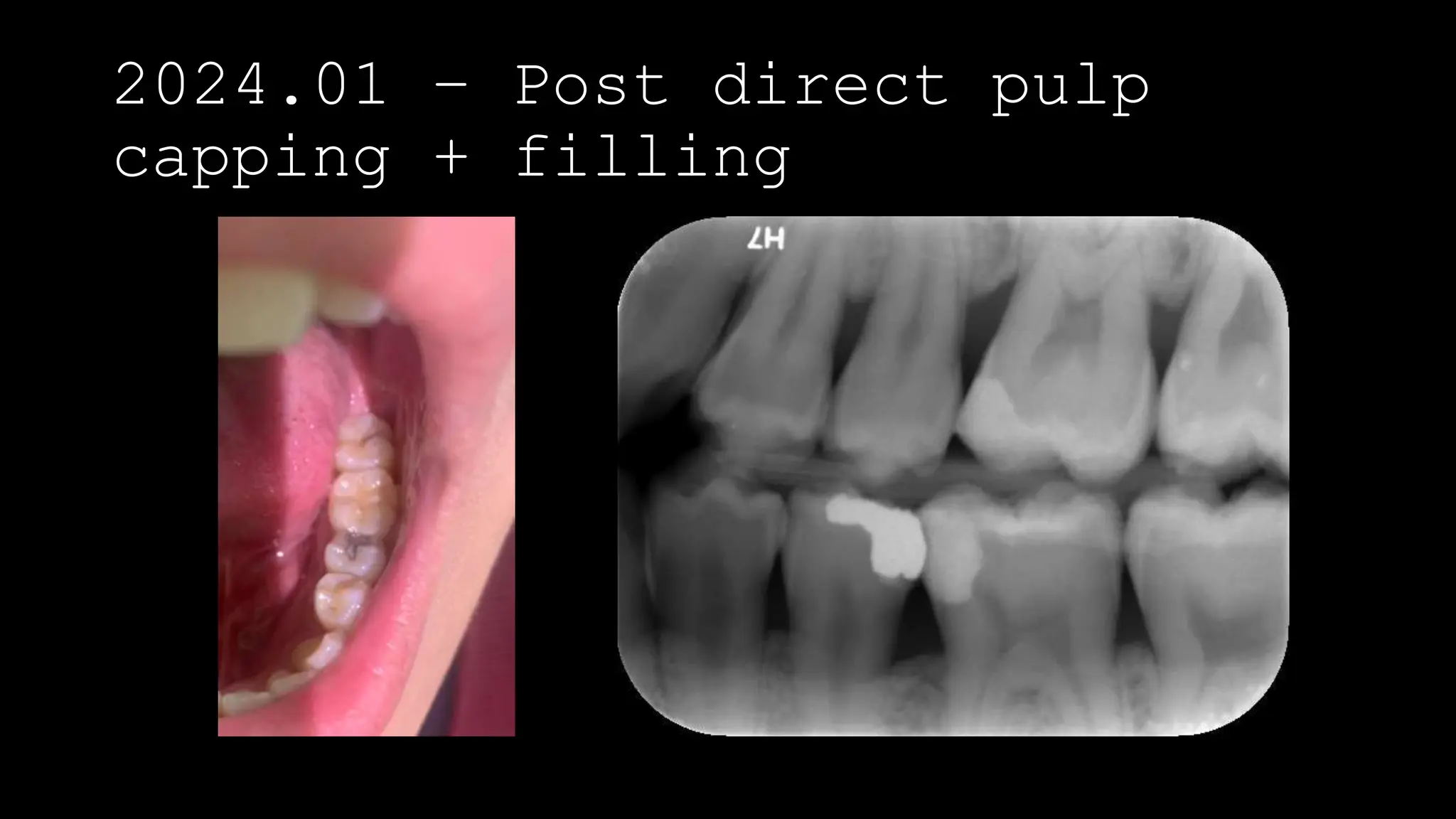 Dental case report on vital pulp therapy | PPTX