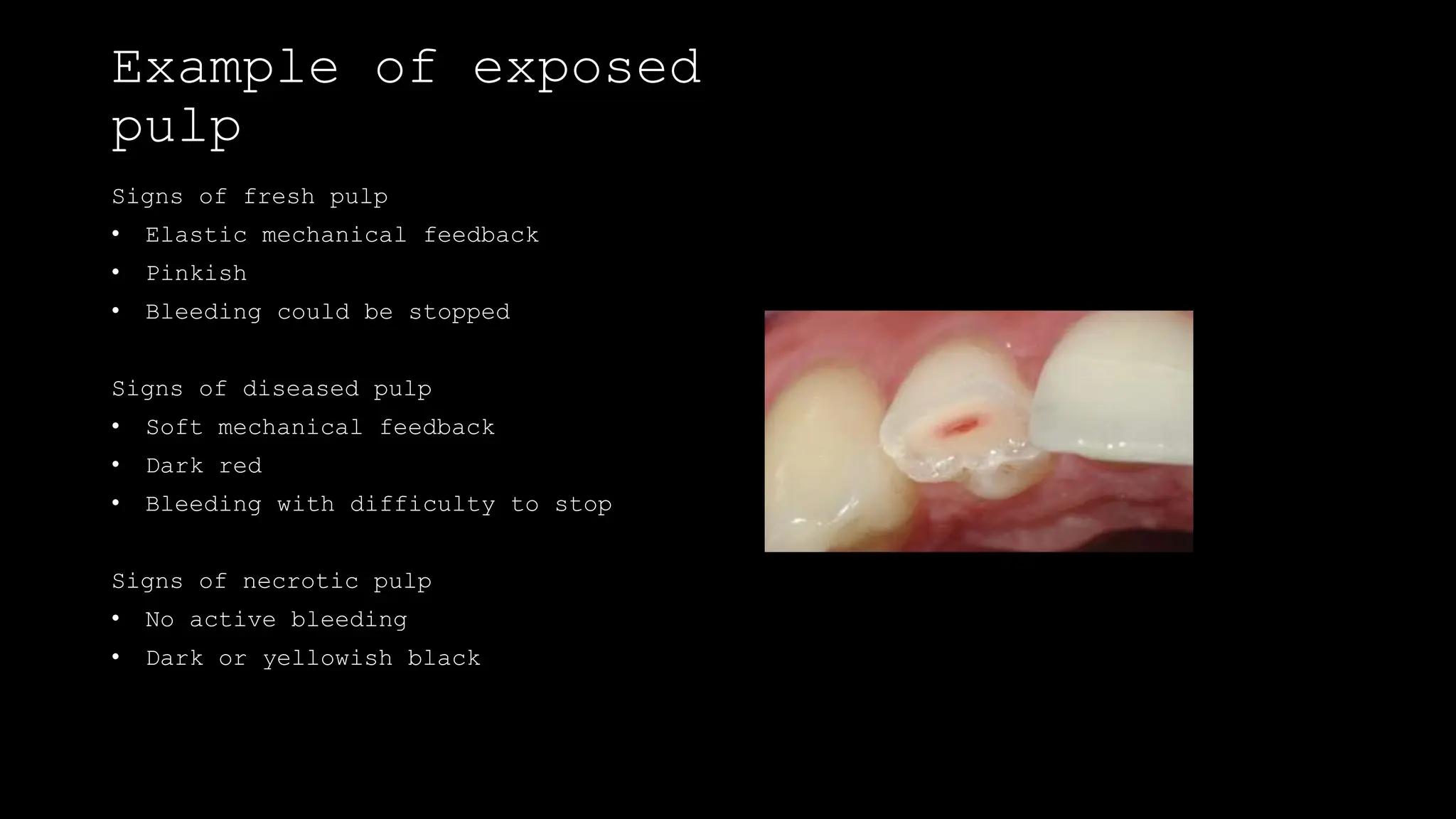Dental case report on vital pulp therapy | PPTX