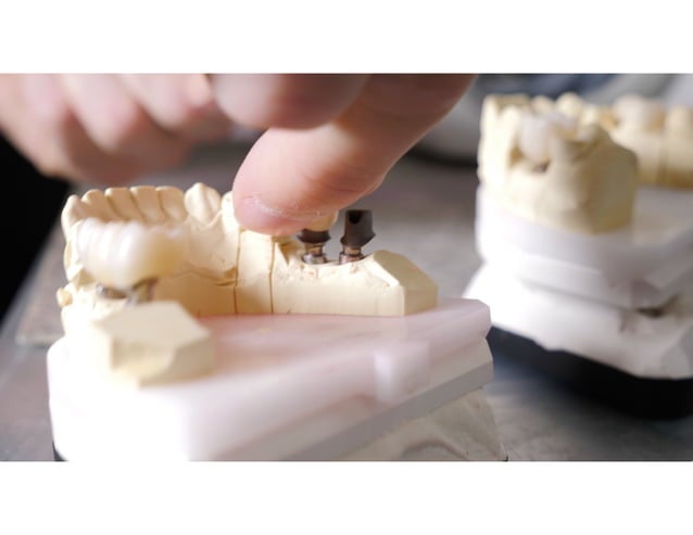 Dental cast for dental implants patient at Refresh Me Dental Center.pdf