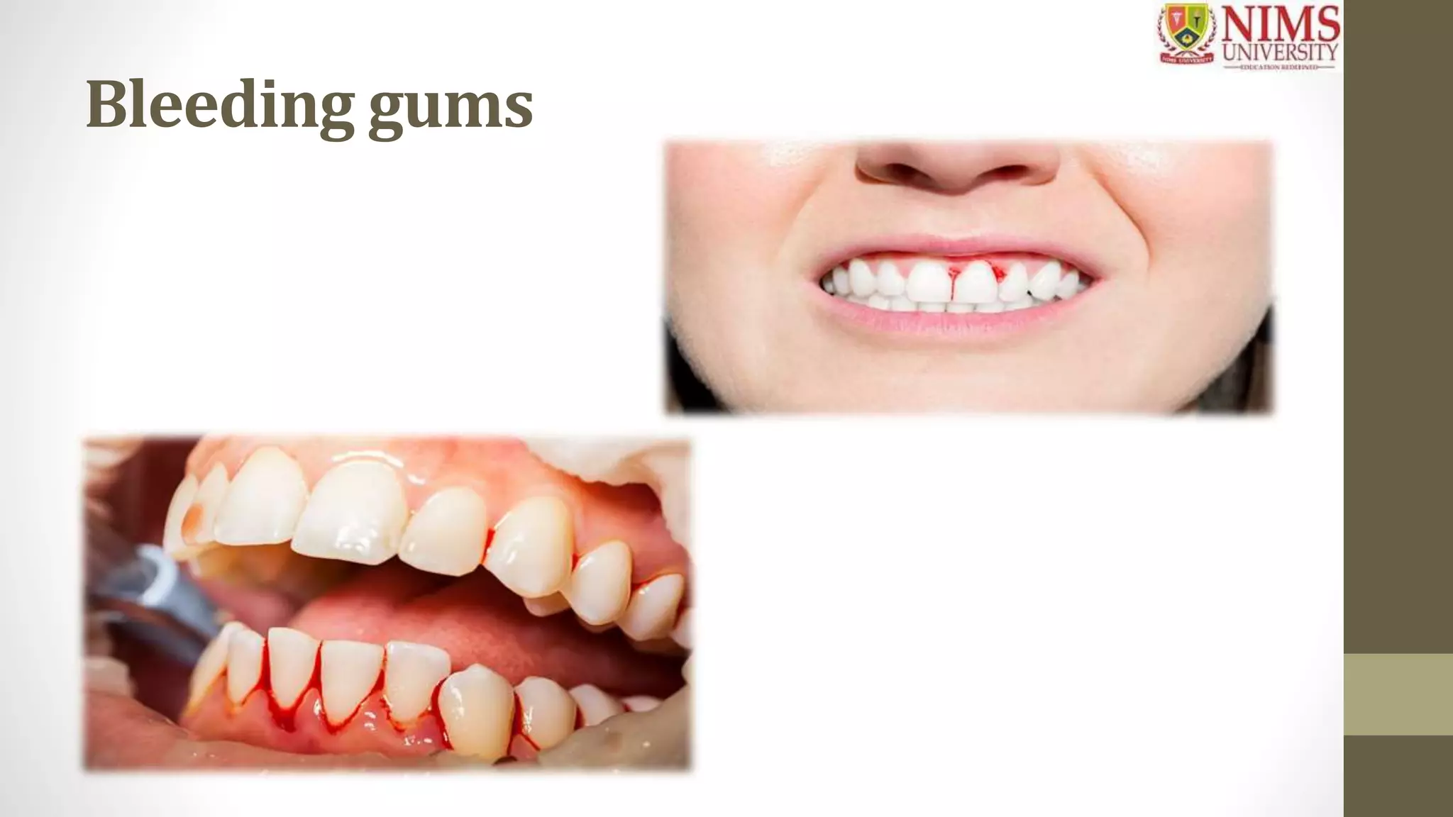 Dental Cavities , Gum , Bleeding ,Mouth.pptx