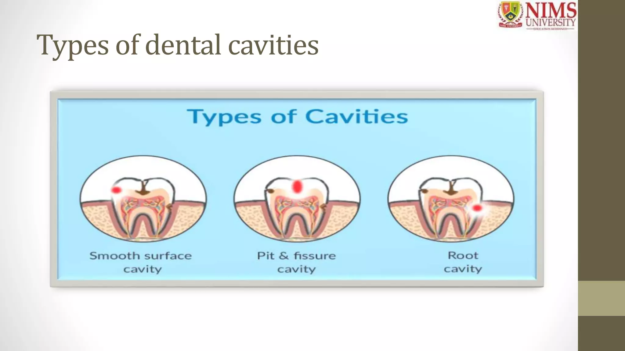 Dental Cavities , Gum , Bleeding ,Mouth.pptx