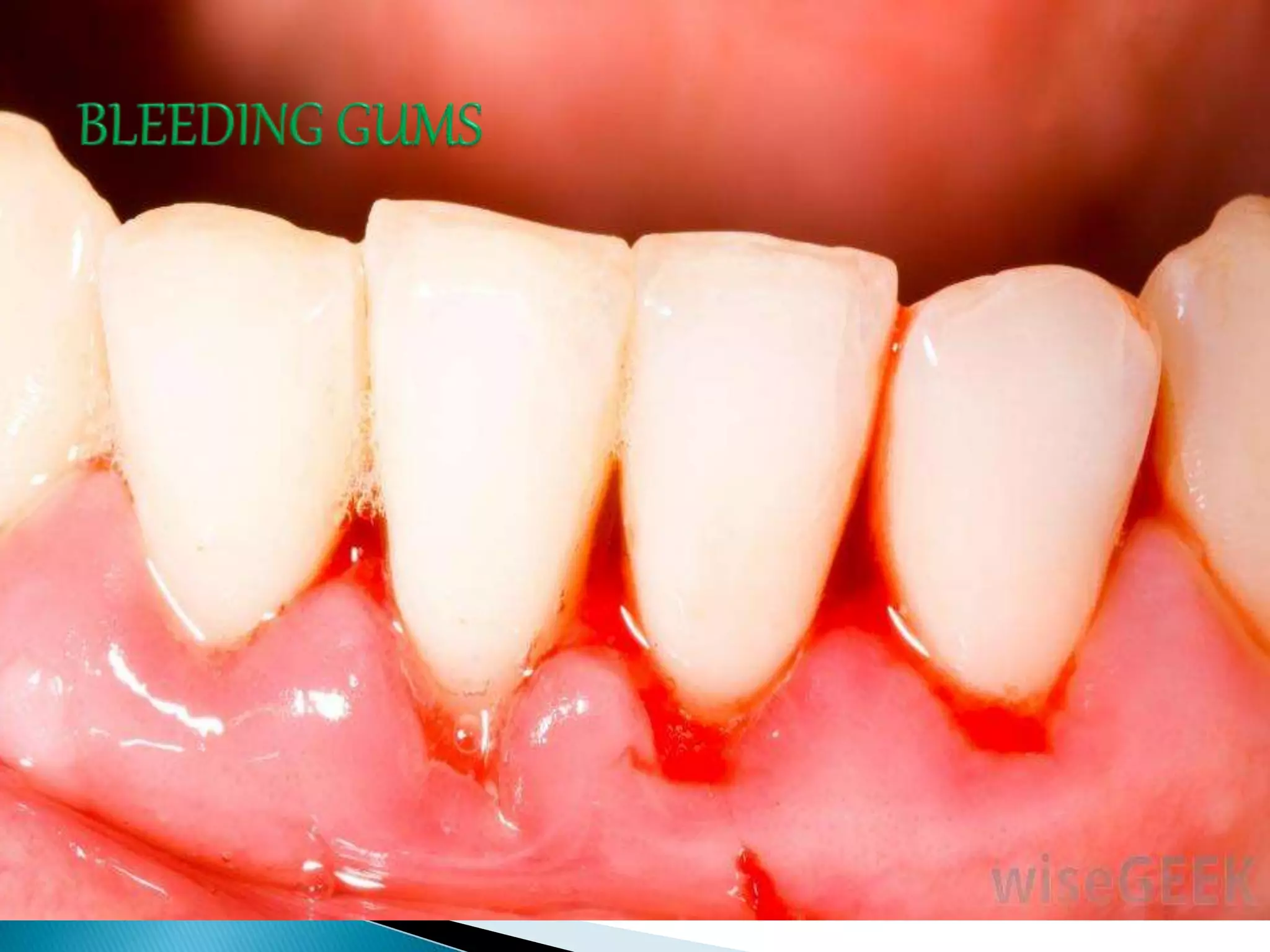 Dental cavities,gum bleeding,mouth odour and sensitive teeth | PPTX
