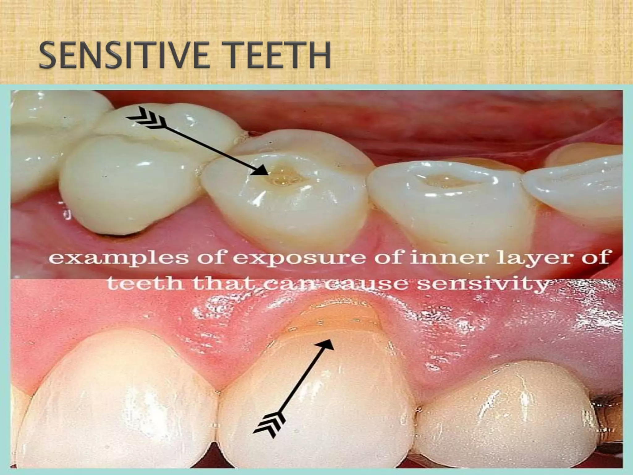 Dental cavities,gum bleeding,mouth odour and sensitive teeth | PPTX