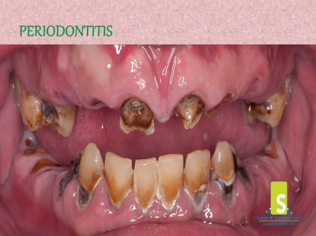 Dental cavities,gum bleeding,mouth odour and sensitive teeth | PPTX