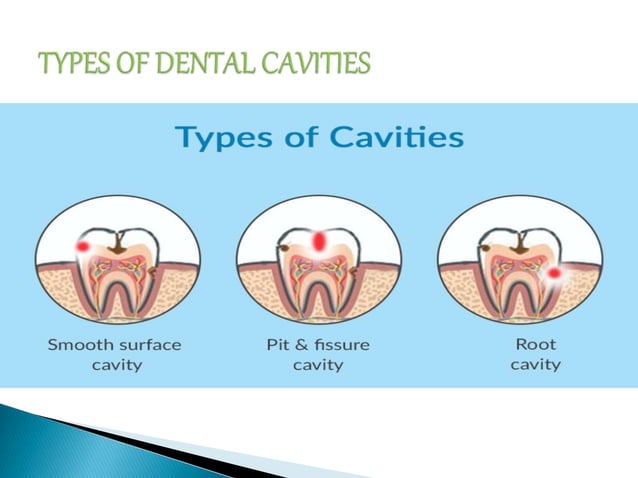 Dental cavities,gum bleeding,mouth odour and sensitive teeth | PPTX