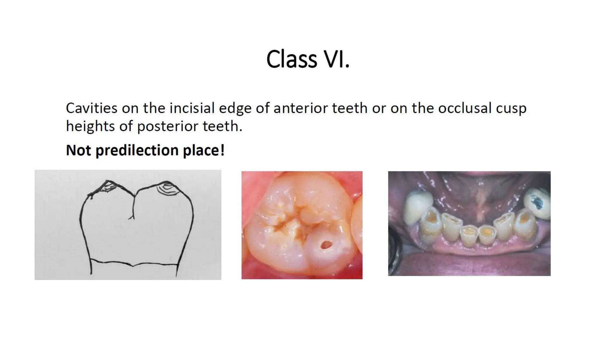 Dental cavity classification systems.PPTX