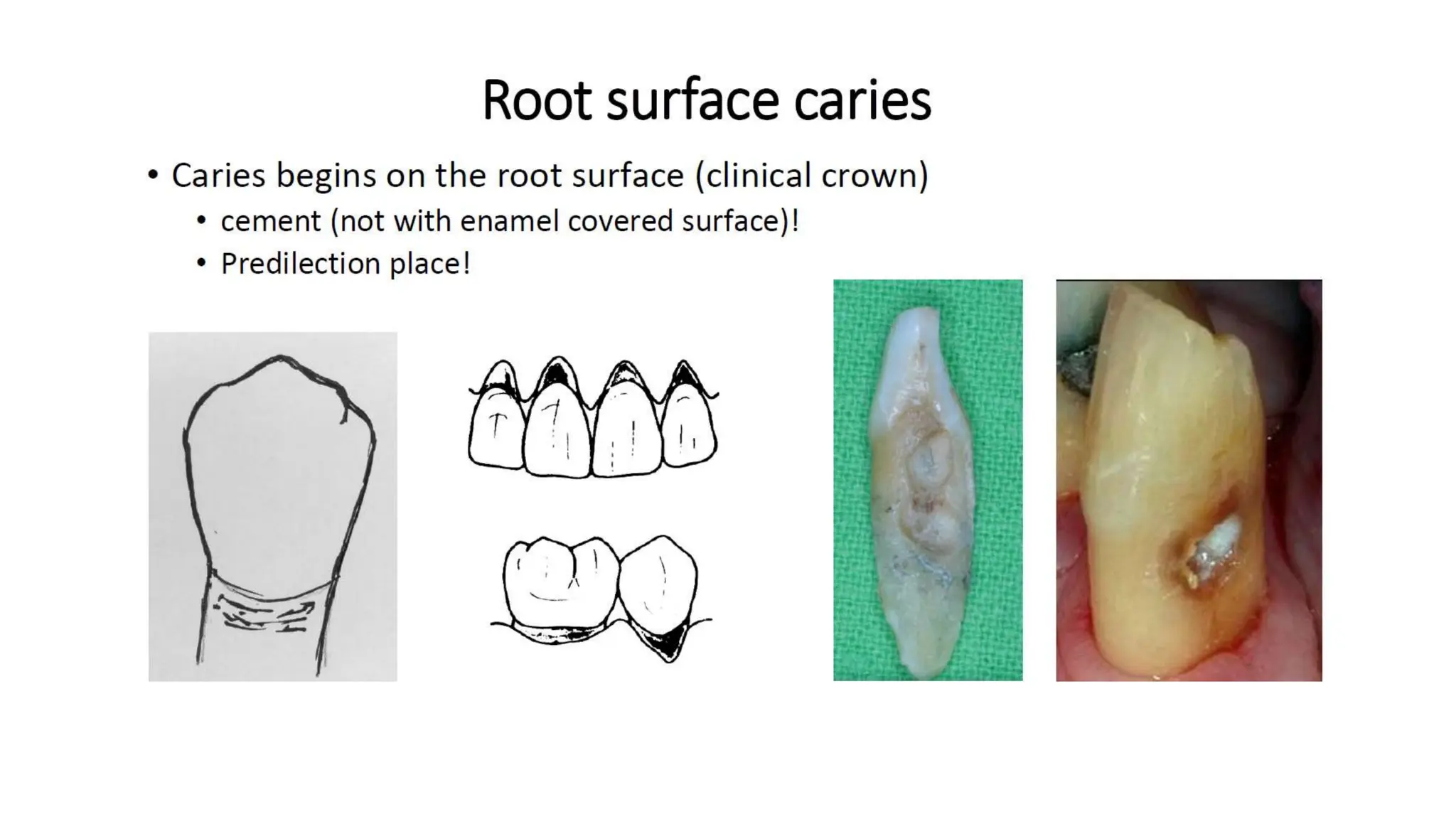 Dental cavity classification systems.PPTX