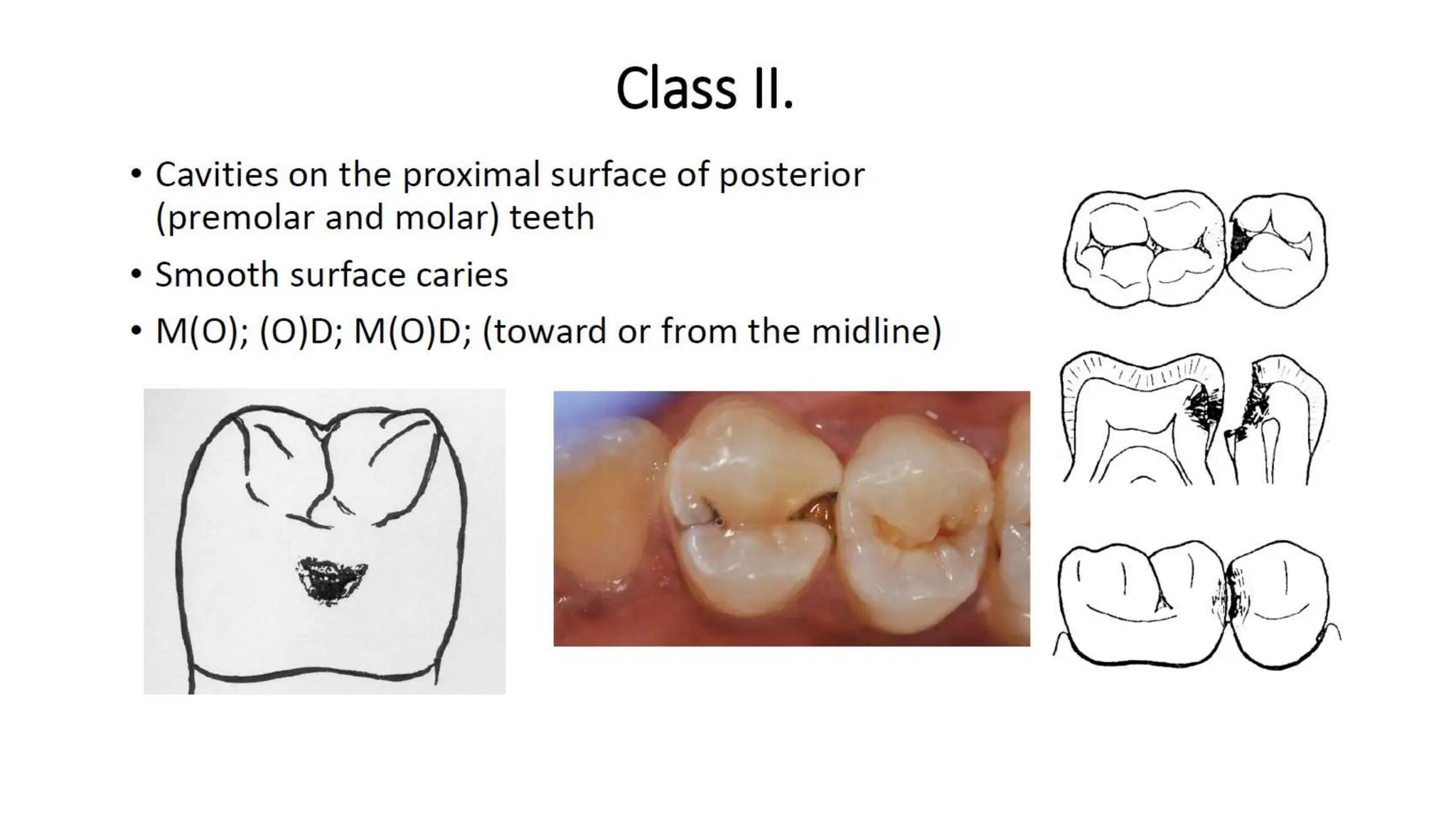Dental cavity classification systems.PPTX