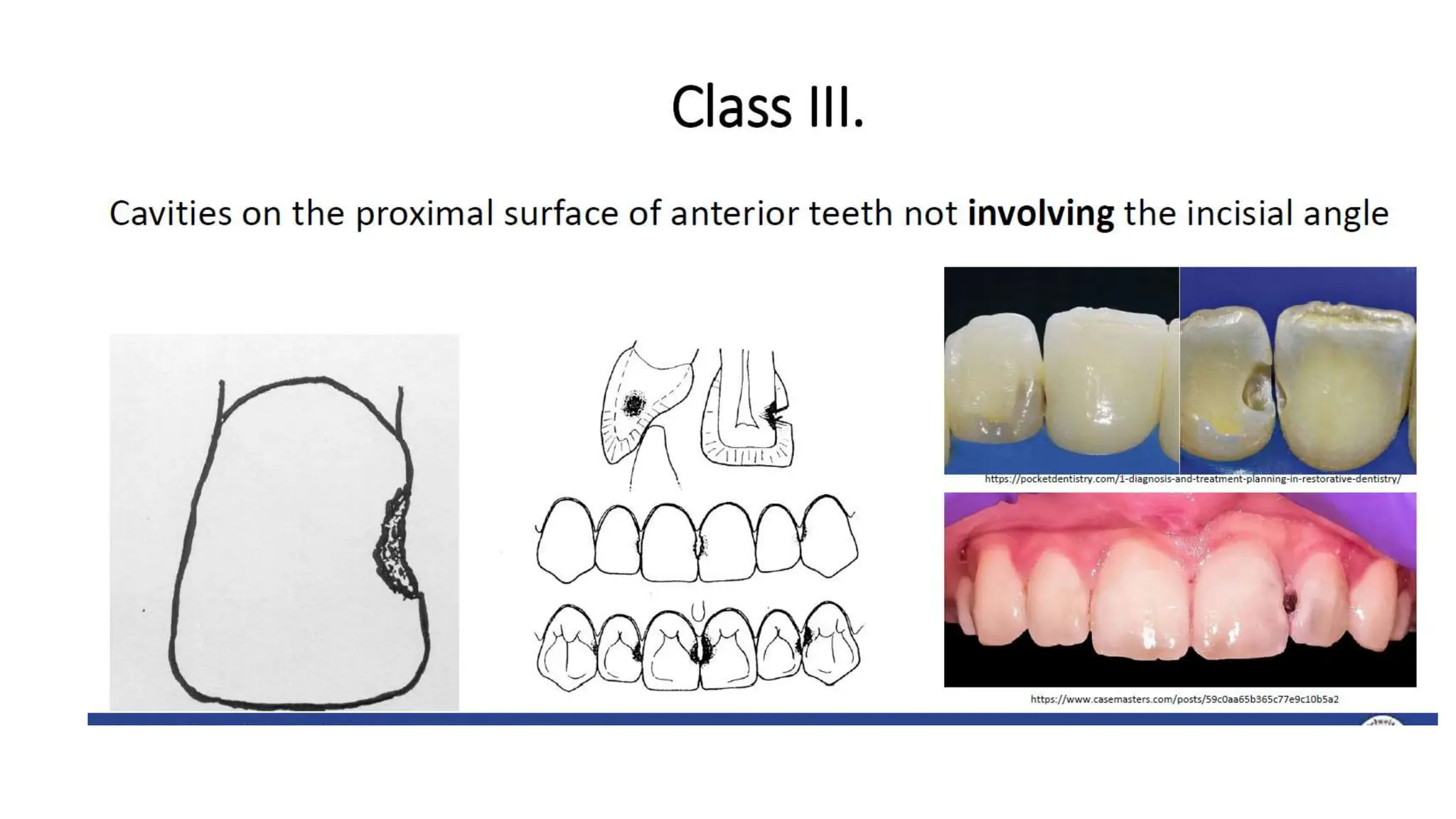 Dental cavity classification systems.PPTX