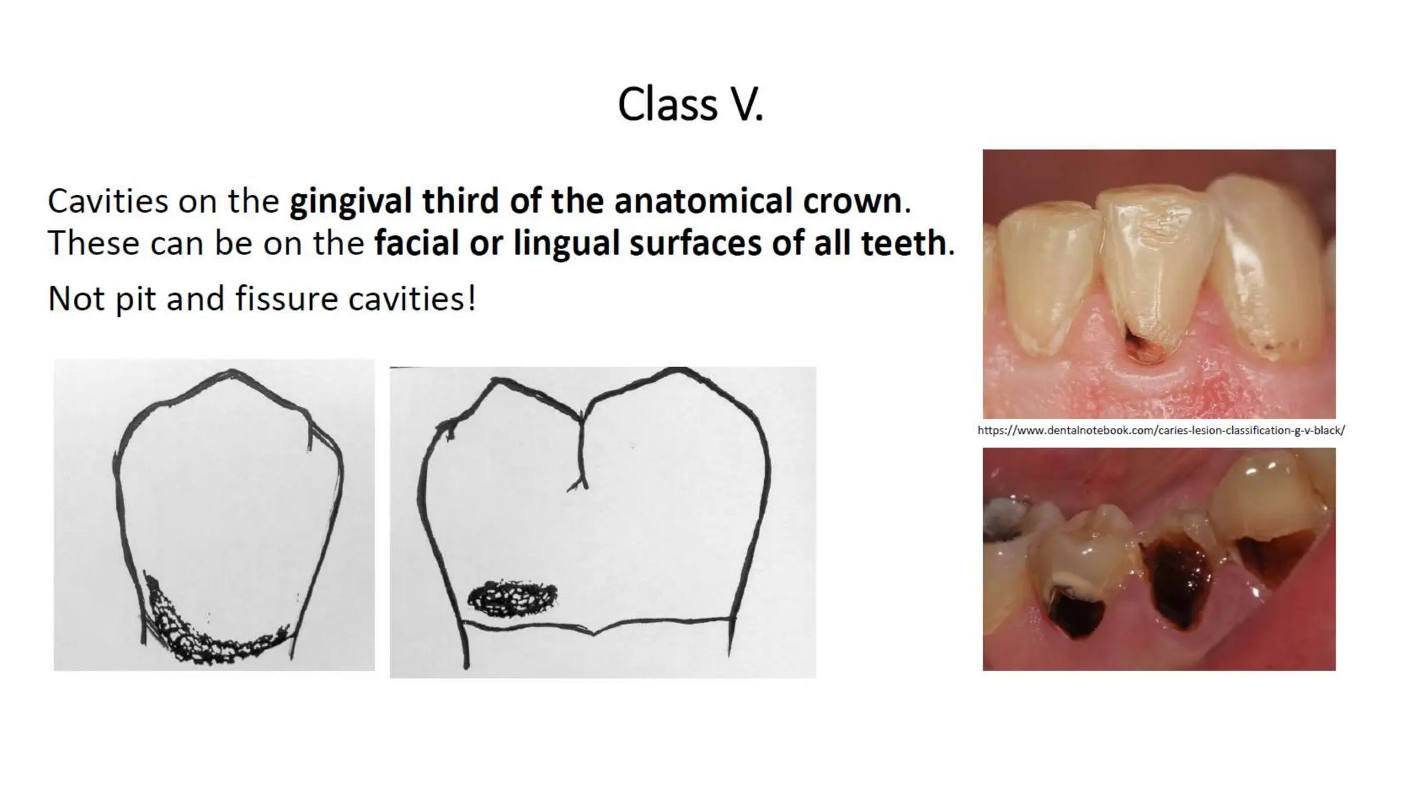 Dental cavity classification systems.PPTX