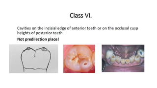 Dental cavity classification systems.PPTX