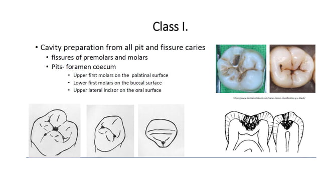 Dental cavity classification systems.PPTX