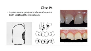 Dental cavity classification systems.PPTX