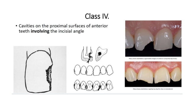 Dental cavity classification systems.PPTX