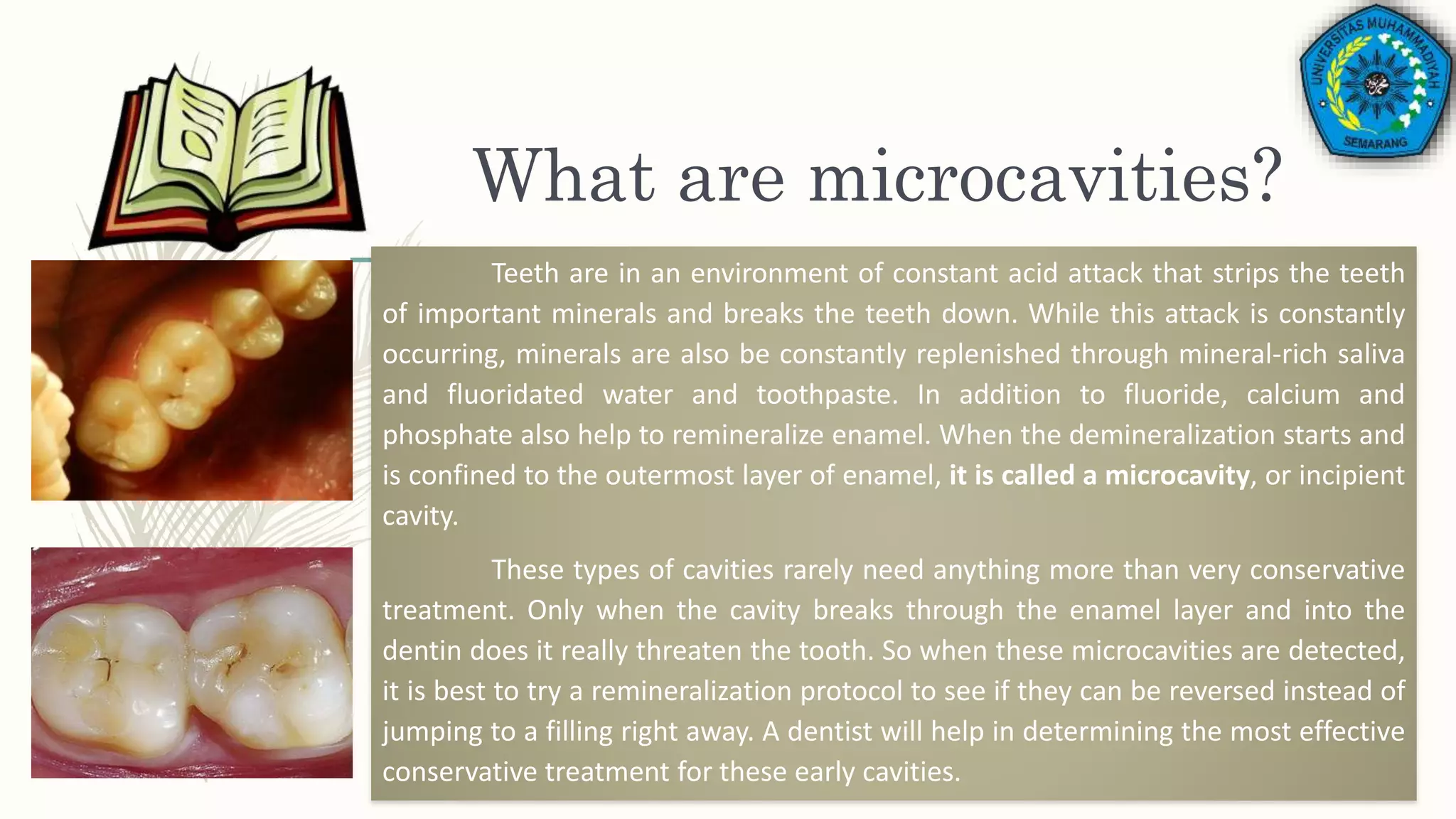 Dental Cavity (Caries) | PPTX