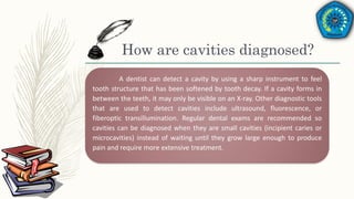 Dental Cavity (Caries) | PPT