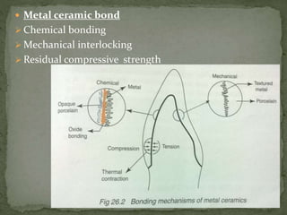 Dental Ceramic in Conservative Dentistry and Endodontics | PPTX