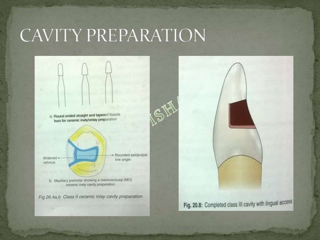 Dental Ceramic in Conservative Dentistry and Endodontics | PPTX