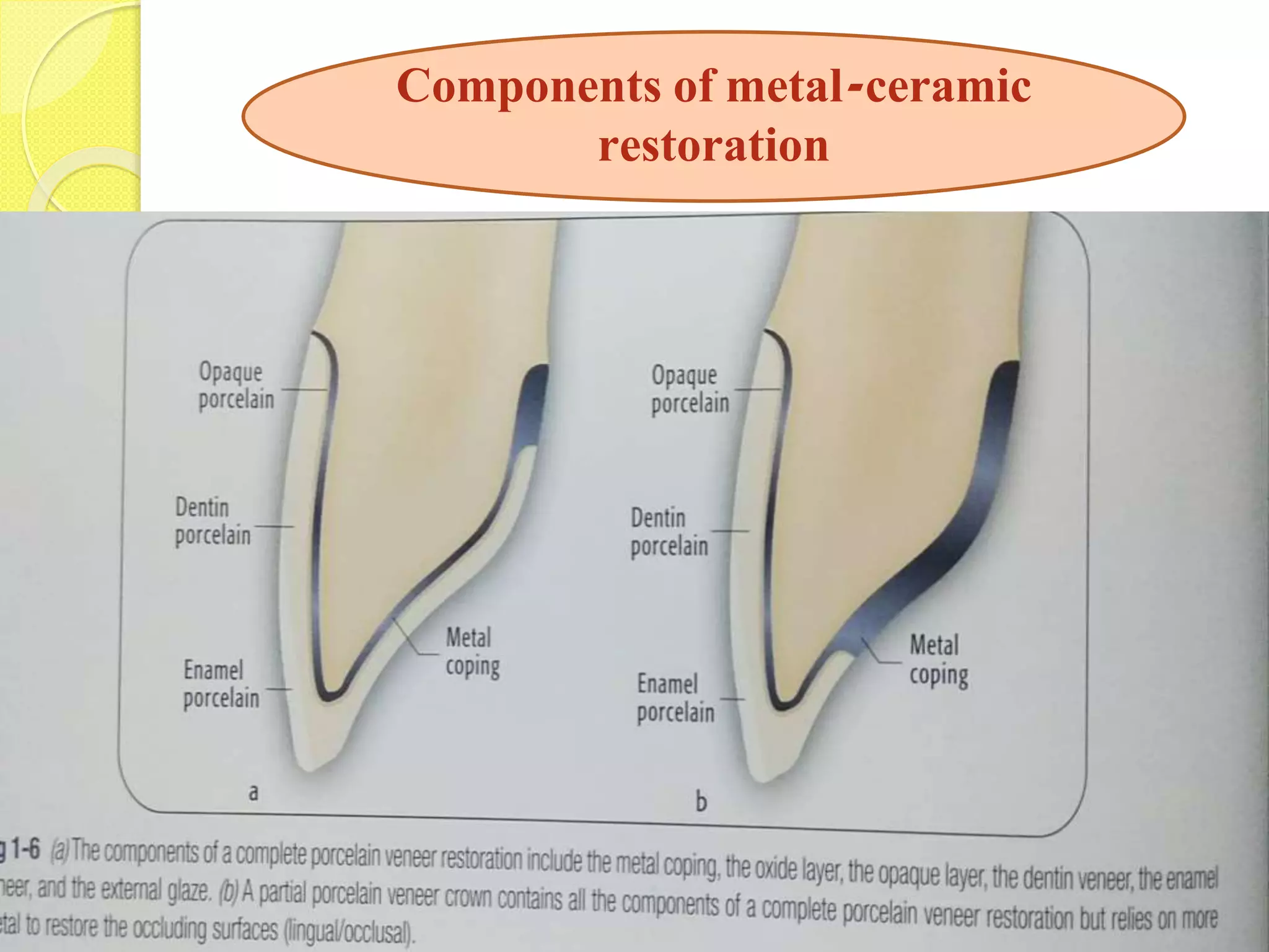 Dental ceramics | PPTX