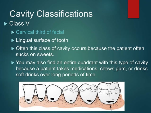 Dental charting, Cavity Classification, Basic Charting Terms | PPTX ...