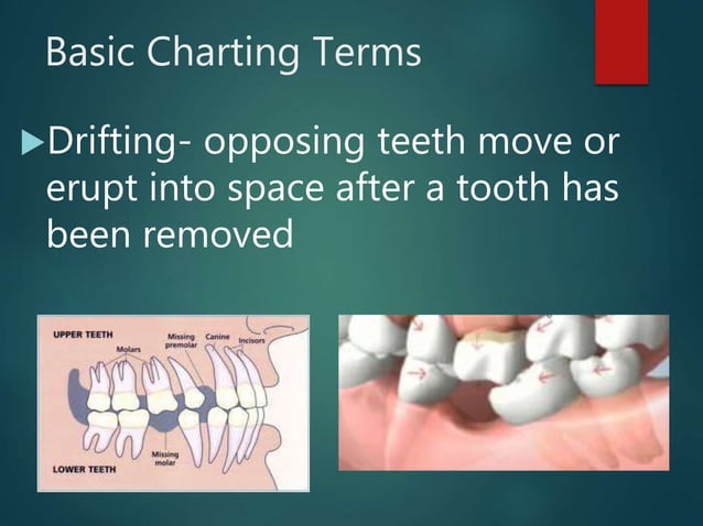 Dental charting, Cavity Classification, Basic Charting Terms | PPTX ...
